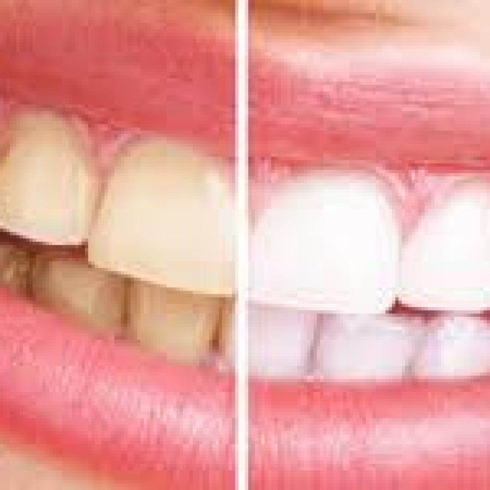Los dientes bonitos no rechinan
