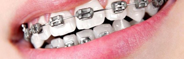 Brackets dentales al cuidado de los dientes. Las respuestas